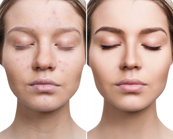 Acne | Skin Cancer & Cosmetic Surgery Center of NJ