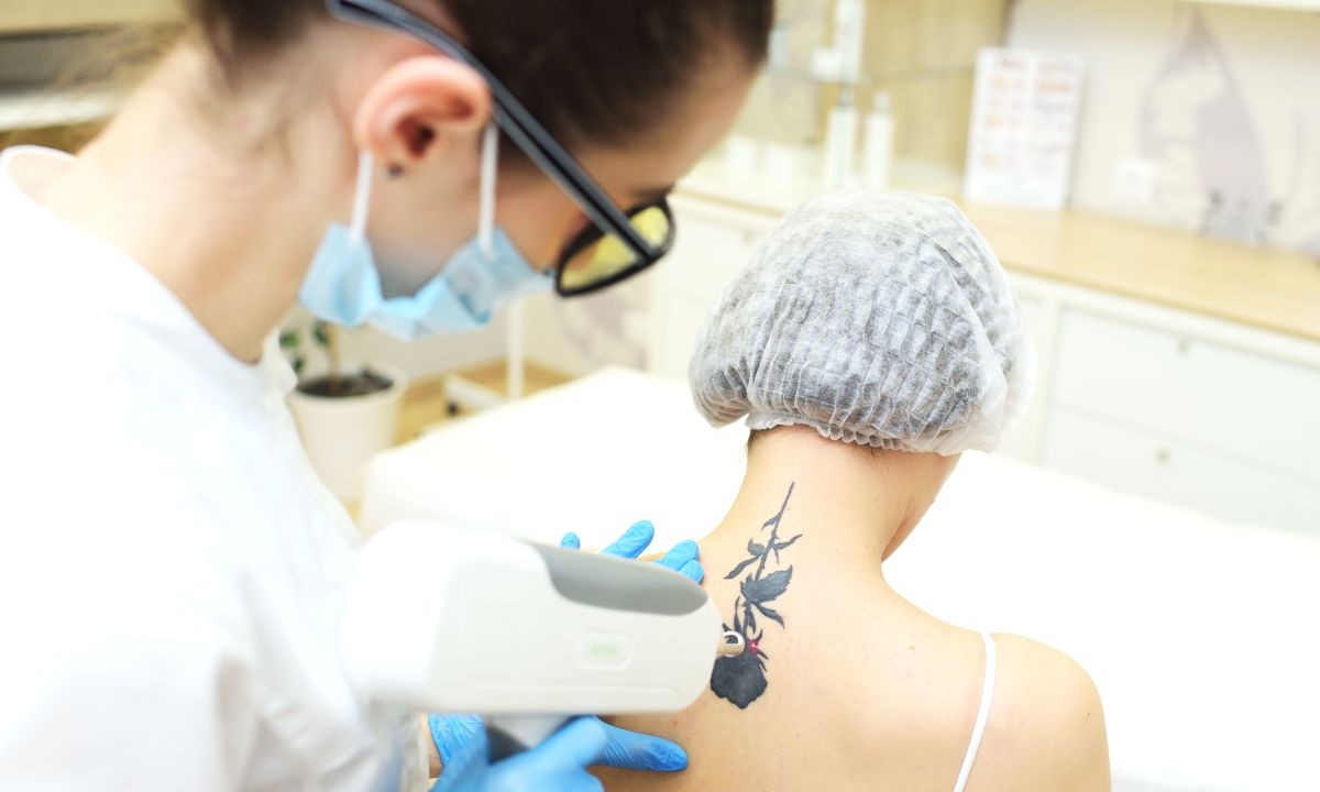 How Does Tattoo Removal Work | Options, Risks & Costs
